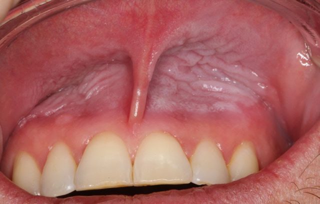 Nicotine Pouches With Built-In Gum Protective Layer Are Endorsed by ...